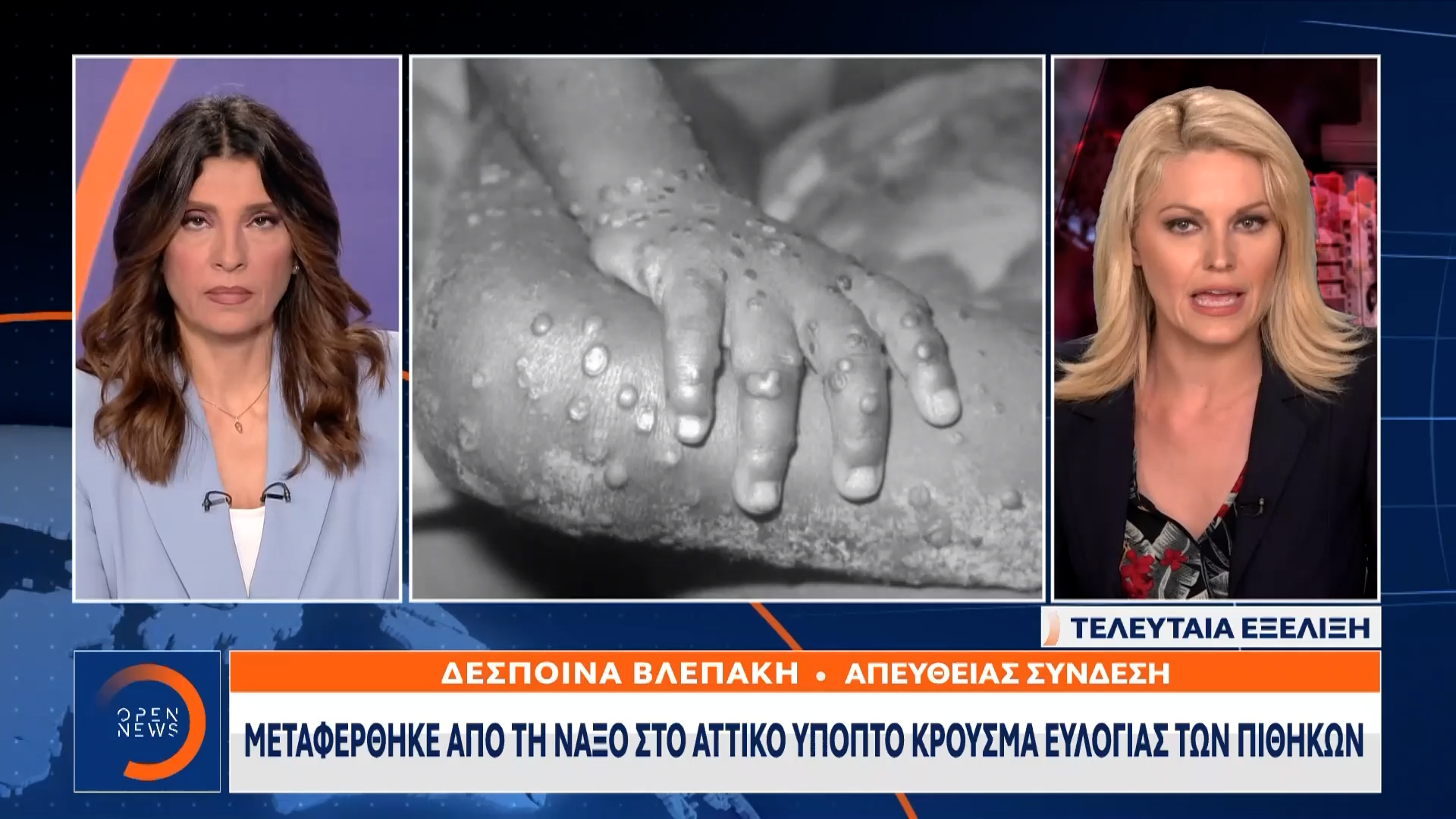 Μεταφέρθηκε από τη Νάξο στο Αττικό, ύποπτο κρούσμα ευλογιάς των πιθήκων ...
