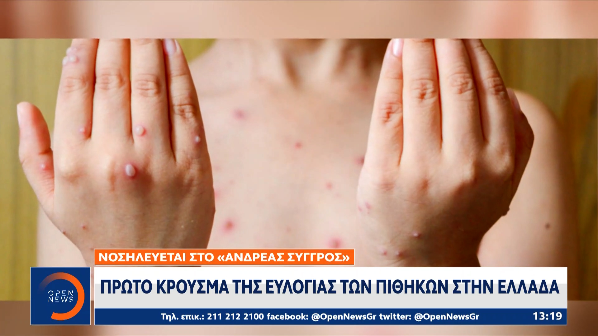 Πρώτο κρούσμα της ευλογιάς των πιθήκων στην Ελλάδα | OPEN TV